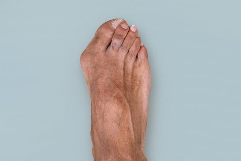 Best Bunion Surgery in Gujarat – Dr. Ankit Kamothi | Hallux Valgus ...