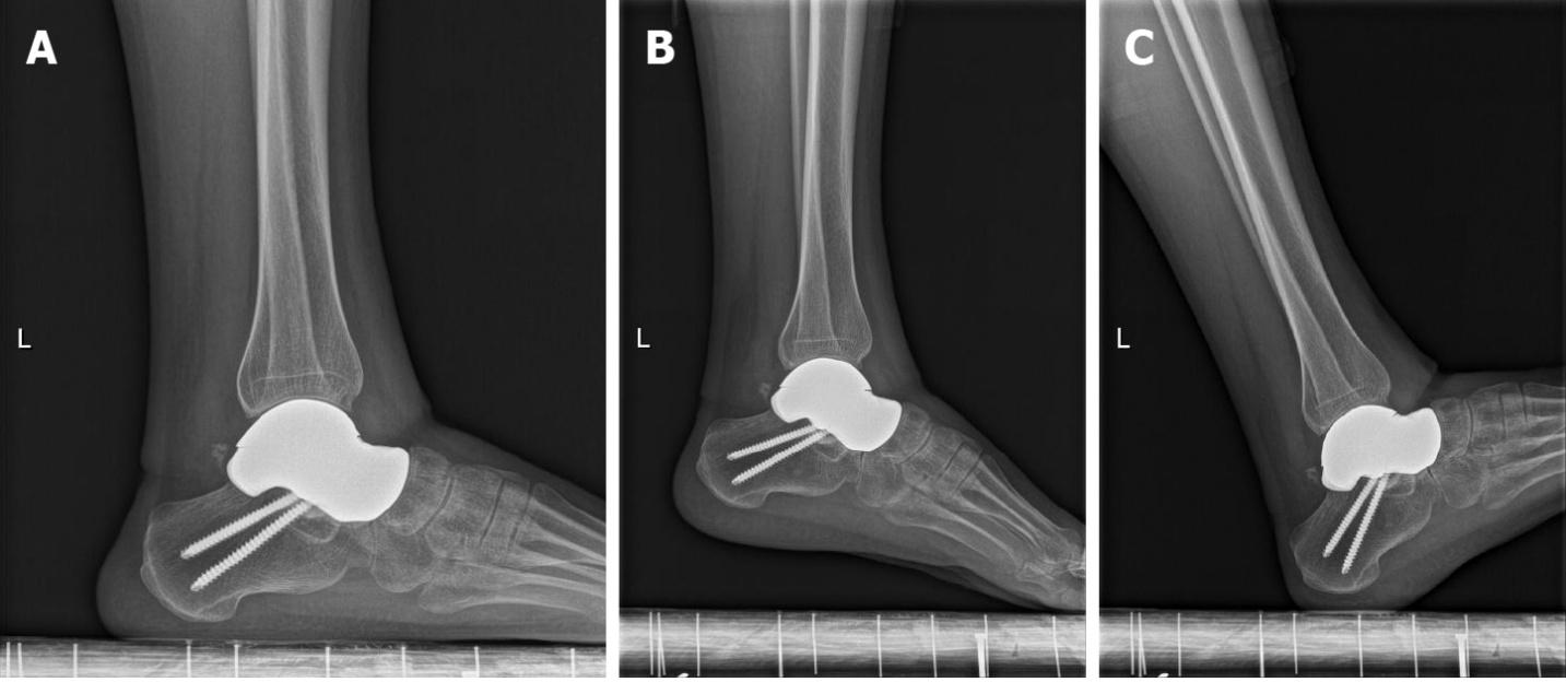 Dr. Ankit Kamothi – Talus Replacement & Prosthesis Surgery in Gujarat